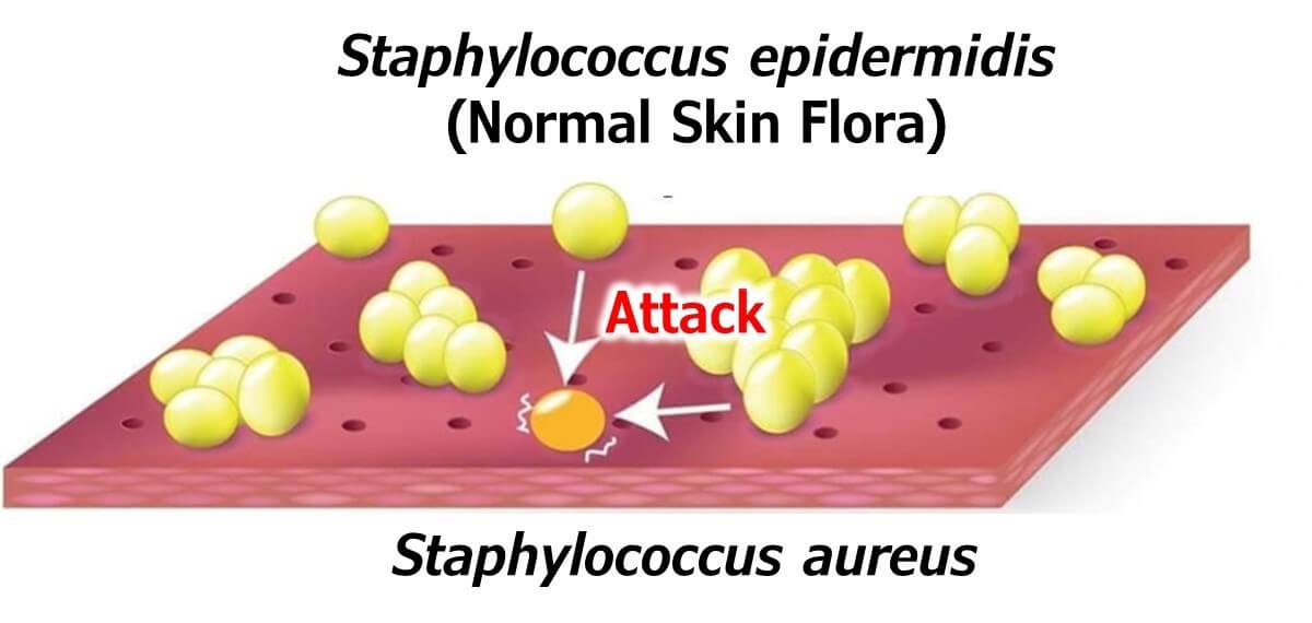 Over Disinfection and Rough Hands: The Role of the Good Indigenous Skin ...